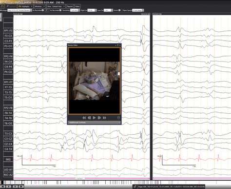 New Cadwell Patent Arc EEG Mouse Tracking For Video