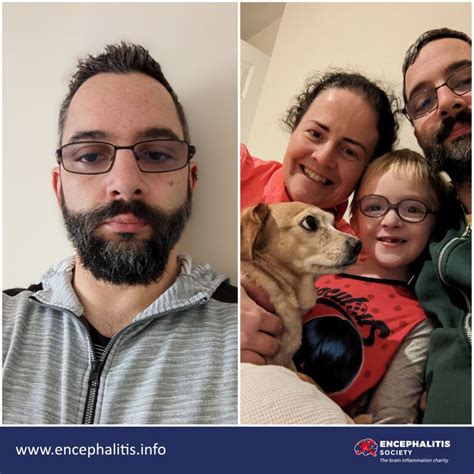 Encephalitisstoryweek Encephalitis Antinmdar Neurology