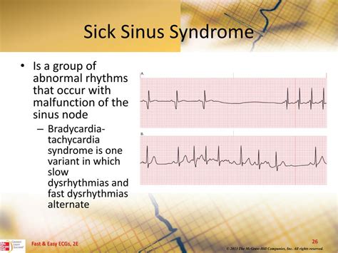 Ppt Sinus Dysrhythmias Powerpoint Presentation Free Download Id