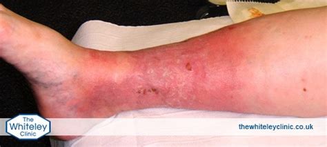 What Is Phlebitis Find Out The Meaning And Definition
