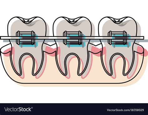 Teeth With Braces And Tooth Root View Royalty Free Vector
