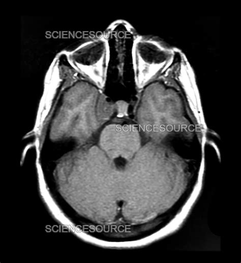 Lymphoma Cavernous Sinus Mri Stock Image Science Source Images