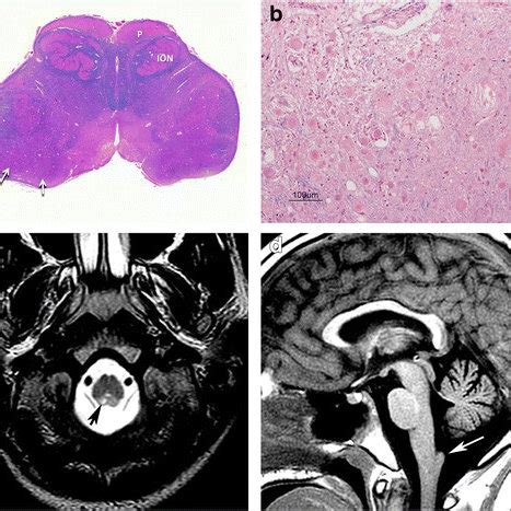 Nucleus Accumbens Sagittal T W Image A Patient At Years Of Age Download Scientific