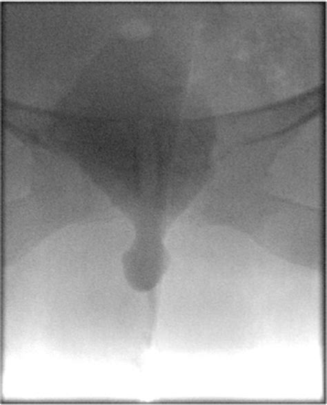Pre Procedural Vcug Which Identified A Normal Appearing Meatus With A Download Scientific