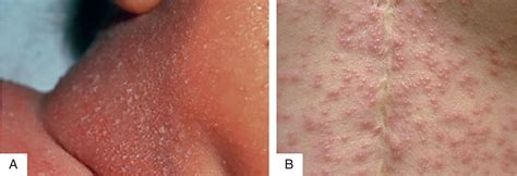 Skin Disorders Innewborn Infants Clinical Tree