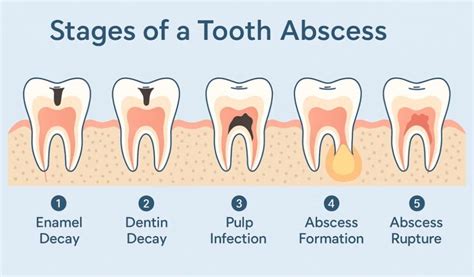 Tooth Abscess Stages Symptoms Treatment And Recovery Guide