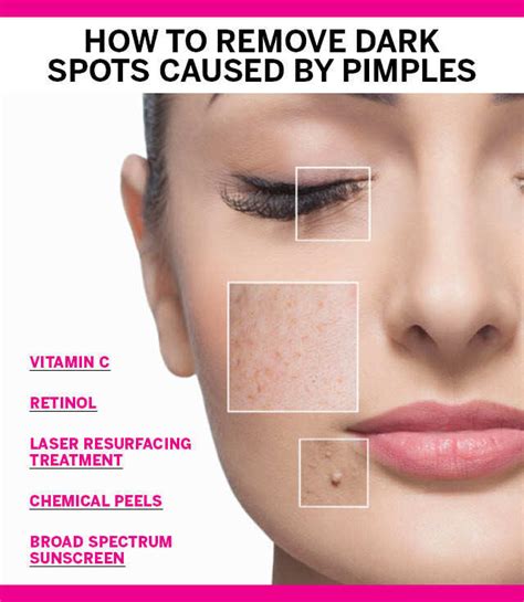 How To Remove Dark Spots Caused By Pimples Femina In