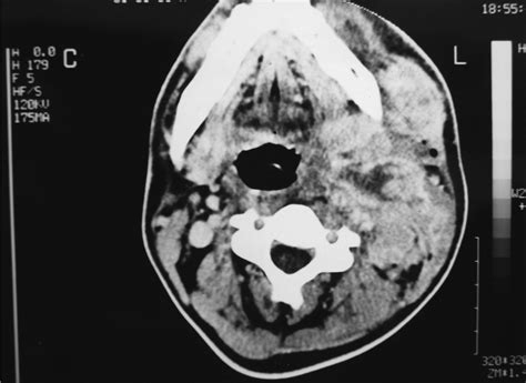 Computed Tomographic Scan For The Patient The Soft Tissue Involvement Download Scientific