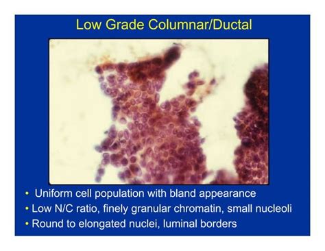 Fna Cytology Of Metastatic Malignancies Ppt