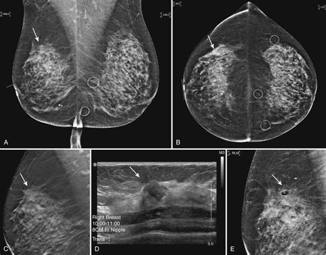Mammographic And Ultrasound Analysis Of Breast Masses Clinical Tree