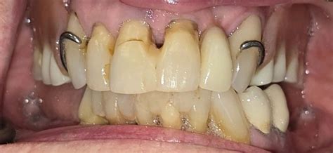 Gurgen Manukyan On Linkedin All On Five Mandibular Fully Guided