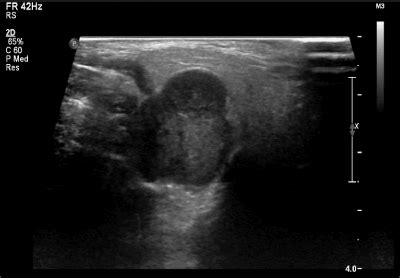 Parotid Gland Tumor Ultrasound