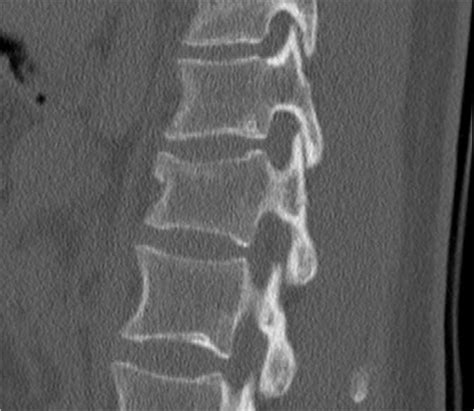 Compression Fracture X Ray