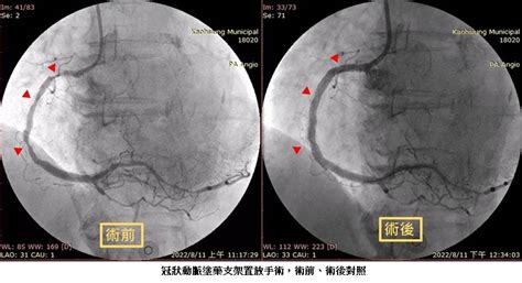 天冷「心痛」 寒流發威 高市聯醫提醒民眾多保暖 慎防心血管疾病發作