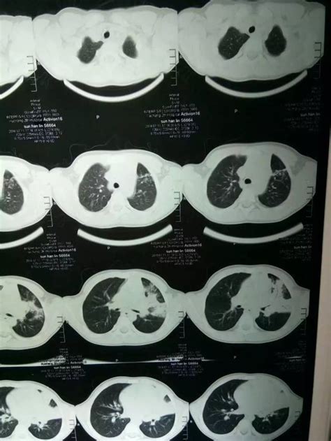 支原体肺炎ct大山谷图库