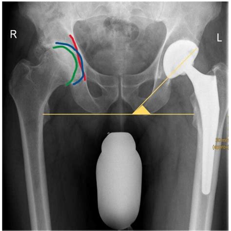 example of a patient with acetabular protrusion of the right r hip