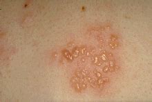 Vesiclebulla