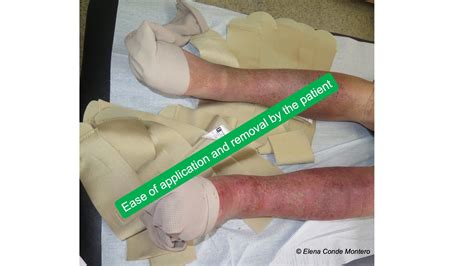Why Are Adjustable Compression Wrap Devices So Popular