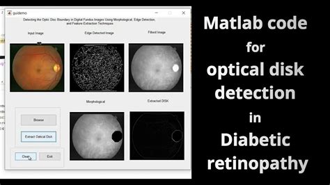 Matlab Code For Optical Disk Detection In Diabetic Retinopathy Diabetes
