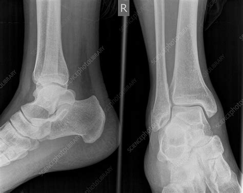 Ankle X Ray Stock Image C0197354 Science Photo Library