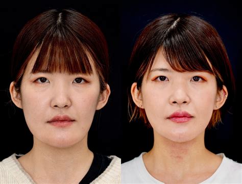 骨切り輪郭セットバック後の両顎手術でシャクレを治す 公式リノクリニック東銀座東京の美容外科美容皮膚科形成外科皮膚科