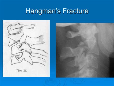Ppt Cns Pathology Powerpoint Presentation Id528134