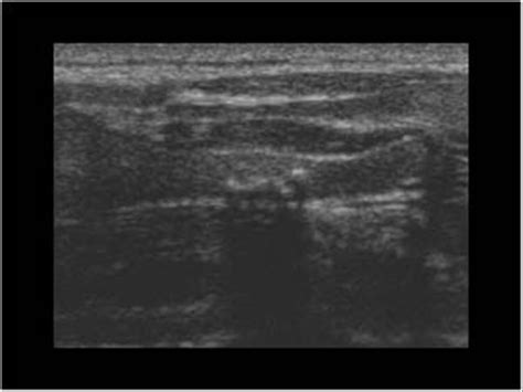 Head And Neck 44 Lymph Nodes Case 441 Benign Lymph Nodes