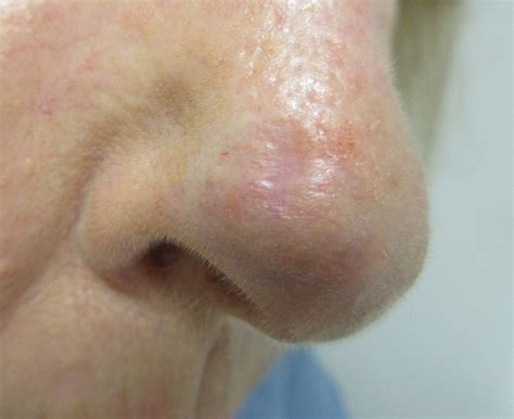 Bcc On The Nose Basal Cell Carcinoma Picture Mr Tehrani Mohs Surgeon
