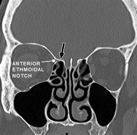The Preoperative Sinus Ct Avoiding A Close” Call With Surgical
