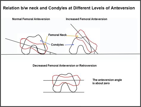 Femoral Anteversion Causes Symptoms And Treatment