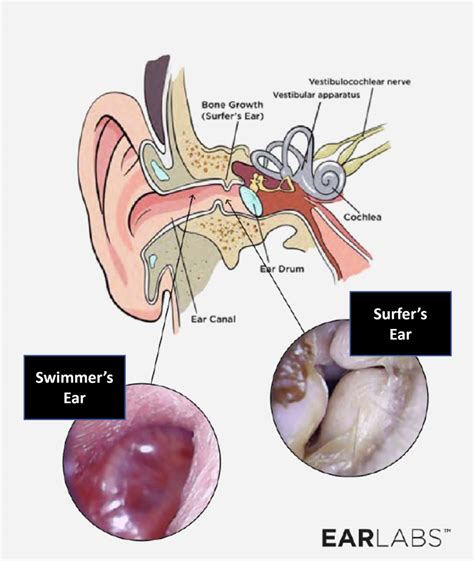 Treatment For Swimmers Ear Otitis Externa 49 Off