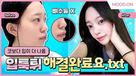 성형 브이로그🎞️ 양악 수술 없이 입 넣기 Lv91857 Feat돌출입 Youtube