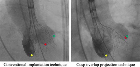 Classical Three Cusp Coplanar Projection Is Shown On The Left Side Download Scientific Diagram
