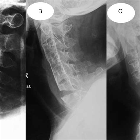 Improved As Cervical Fracture Classification A I Type With Separated