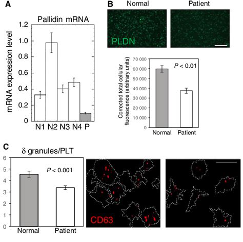 Pallidin Pldn Expression And Cd63 Positive Dense Granules In Patient Download Scientific