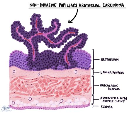 Your Pathology Report For Papillary Urothelial Carcinoma