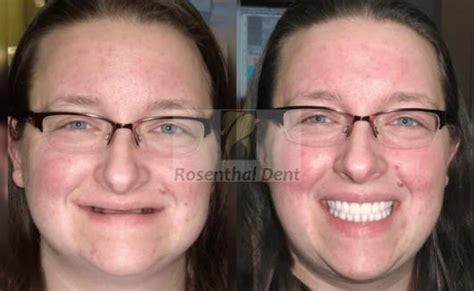 Flexible Nesbit Flipper Denture 1 3 Tooth Partial Order Online