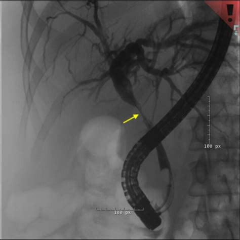 Endoscopic Retrograde Cholangiopancreatography Showing A Single Severe