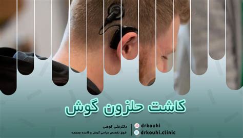 انواع کاشت حلزون گوش آشنایی با کاشت حلزون و نوع های آن