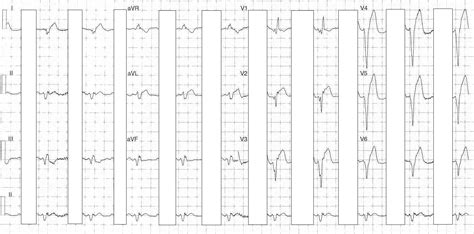 ECG Of The Week ECG Of The Week St February Interpretation