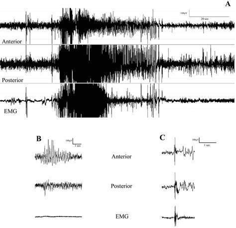 Examples Of Electrographic Eeg Recordings Of Various Seizure