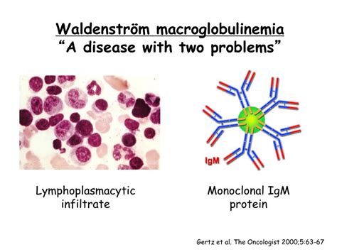 Ppt Waldenström Macroglobulinemia Powerpoint Presentation Free