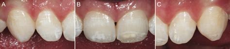 How To Treat Fluorosis Morning Huddle