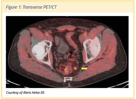 Axumin™ Fluciclovine F18 An Accurate Imaging Approach For Patients