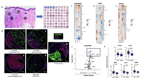 Psrc Proteomic Profiling Of Tumor Microenvironment In Desmoplastic