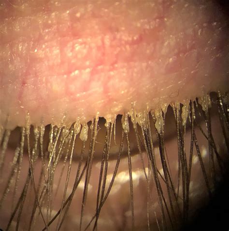 Eyelash Mites Demodex Blepharitis Causes Symptoms And Treatments Iseeu Optometry