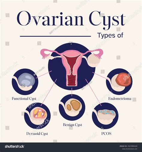 Female Reproductive System Types Ovarian Cyst Stock Vector Royalty Free Shutterstock