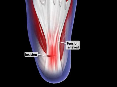 Video Plantar Fascia Release Open Technique Healthclips Online