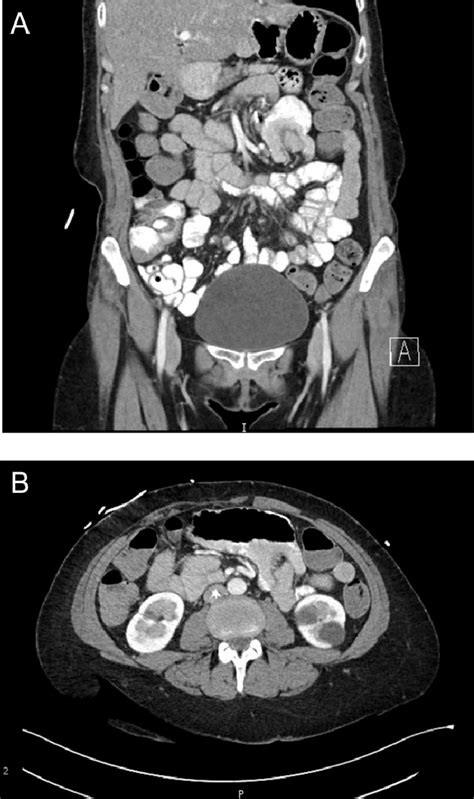 A Evidence Of Intussusception On Ct Scan Coronal View