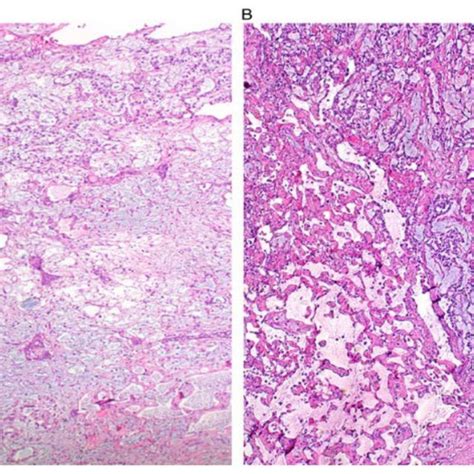 Myxoid Appearance Myxoid Matrix Occupying Much Of The Stroma A And Download Scientific